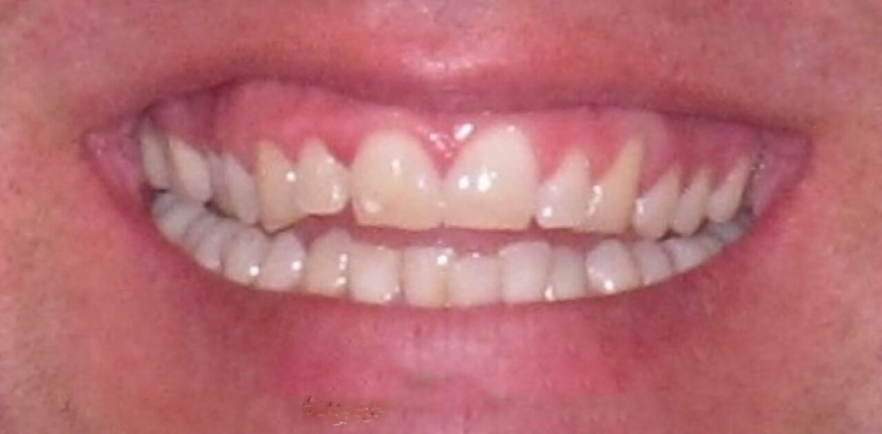 Treatment Options | aligned. | Invisalign & Braces | Denver, CO