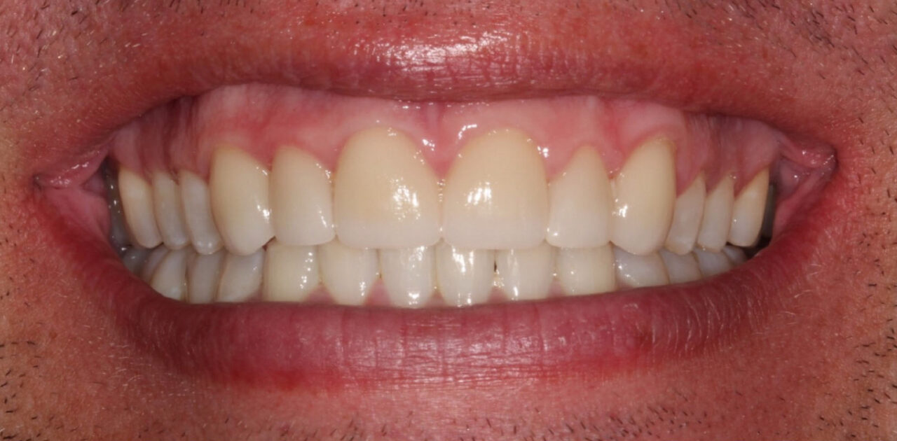 Treatment Options | aligned. | Invisalign & Braces | Denver, CO